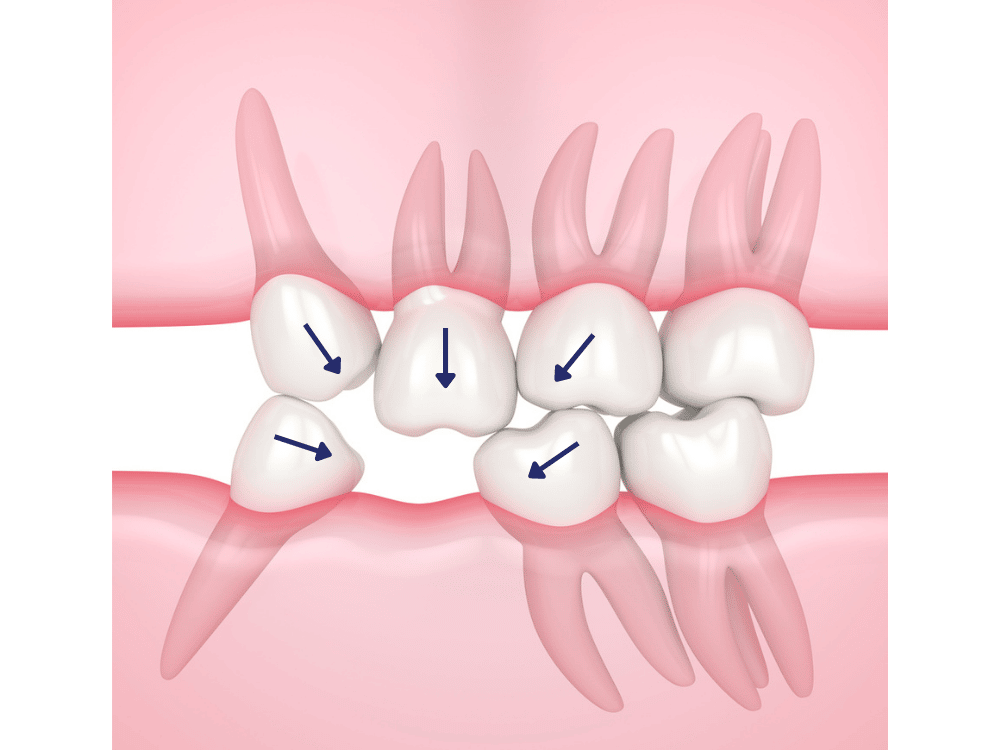 Missing teeth: What are the tooth replacement options | Smilefocus Dentist